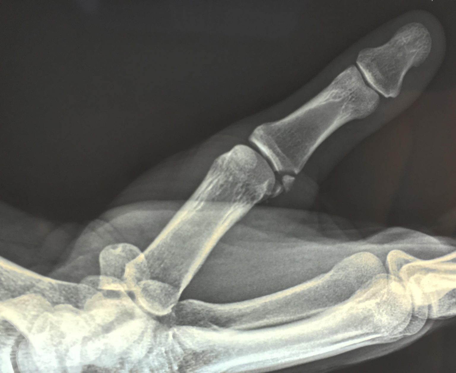 Entorse du pouce à Bordeaux Mérignac | Chirurgie Main & Poignet