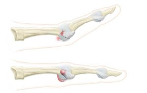 Entorse IPP des doigts à Bordeaux Mérignac | Chirurgie de la Main