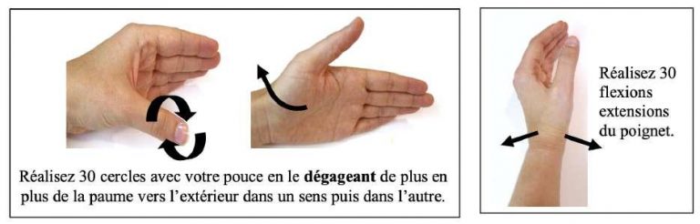 Rhizarthrose à Bordeaux Mérignac | Chirurgie de la main | 33