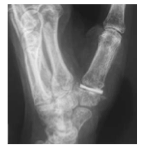 Rhizarthrose à Bordeaux Mérignac | Chirurgie de la main | 33