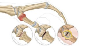 Rhizarthrose à Bordeaux Mérignac | Chirurgie de la main | 33