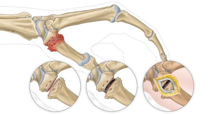 Rhizarthrose à Bordeaux Mérignac | Chirurgie de la main | 33