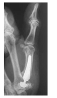 Rhizarthrose à Bordeaux Mérignac | Chirurgie de la main | 33