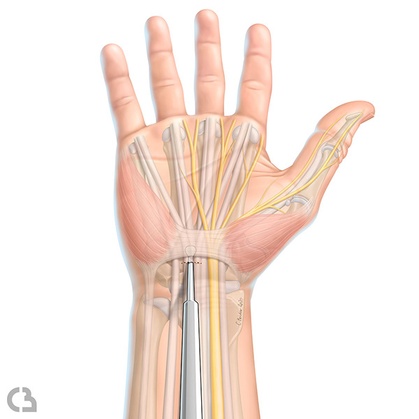 Syndrome du Canal Carpien à Bordeaux | Chirurgie Main & Poignet