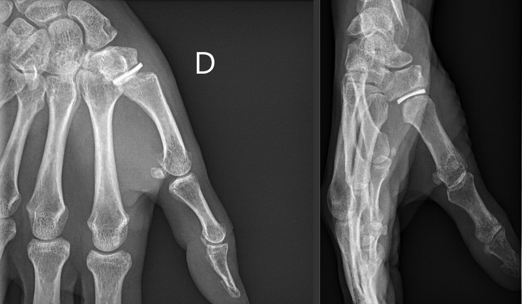 Rhizarthrose à Bordeaux Mérignac | Chirurgie de la main | 33