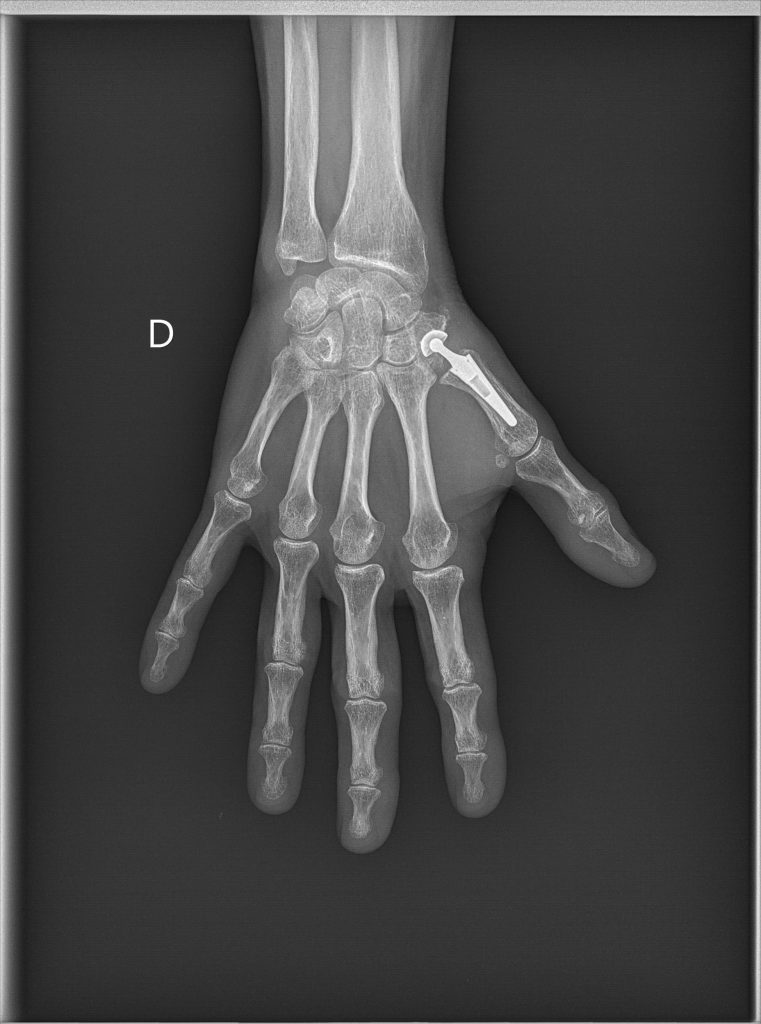 Rhizarthrose à Bordeaux Mérignac | Chirurgie de la main | 33