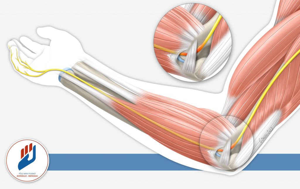 Syndrome du tunnel carpien à Bordeaux | Chirurgie de la Main 33