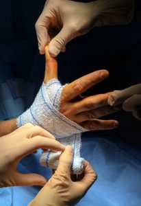 Arthroplasties d'Interposition à Pyrocarbone dans le traitement de la ...