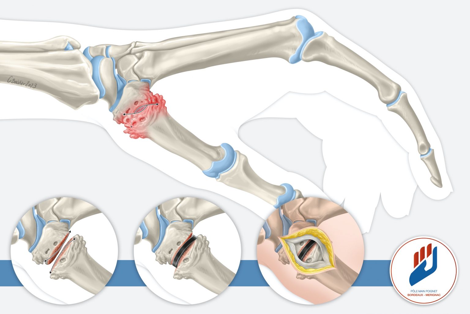 Entorse IPP des doigts à Bordeaux Mérignac | Chirurgie de la Main