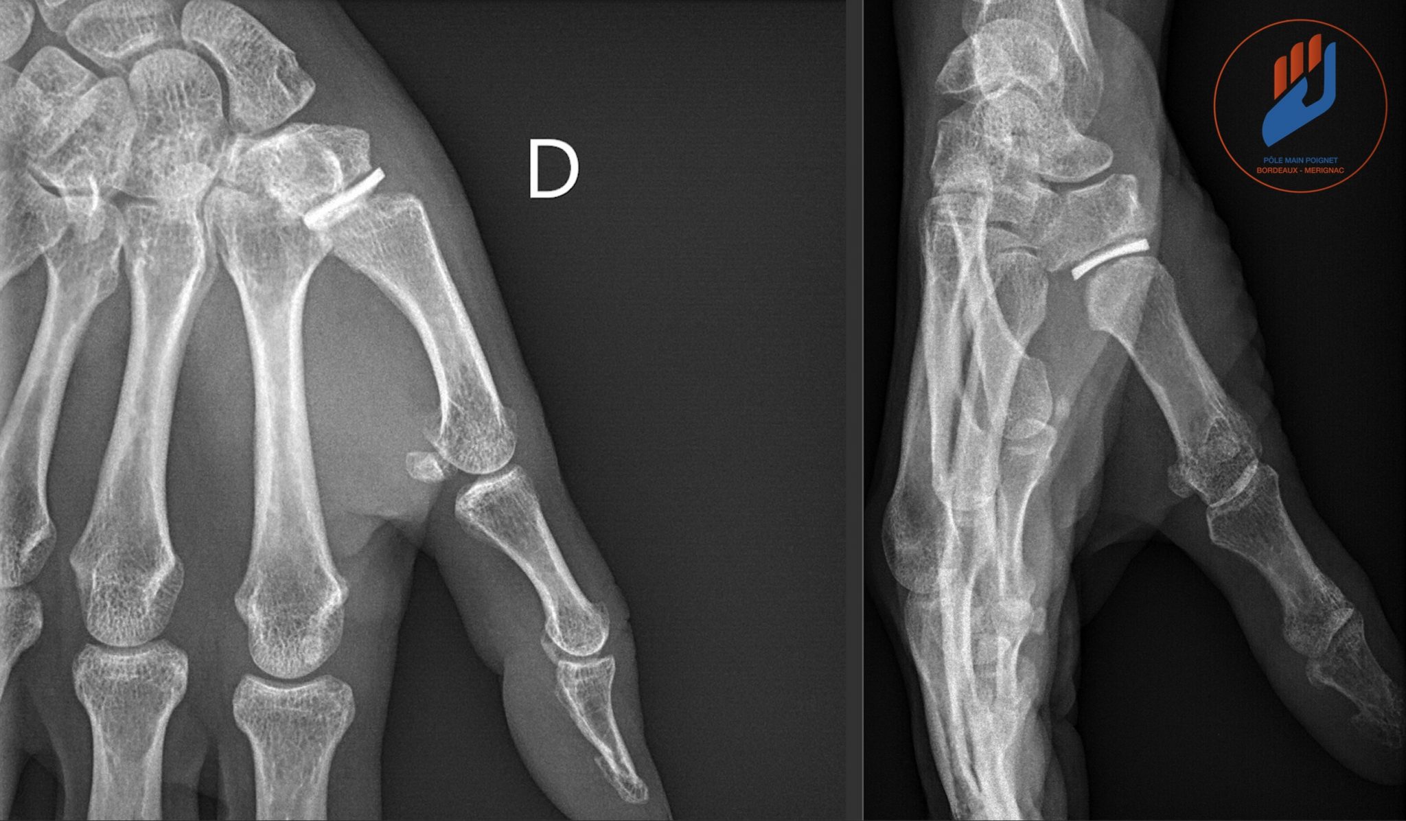 Arthroplasties d'Interposition à Pyrocarbone dans le traitement de la ...