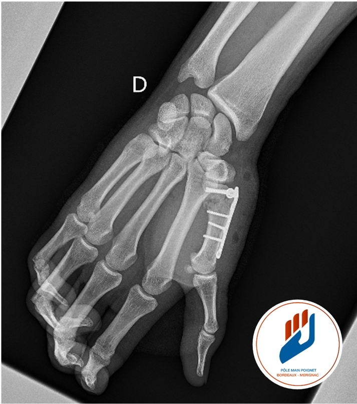Fracture de la base du premier métacarpien à Bordeaux Mérignac