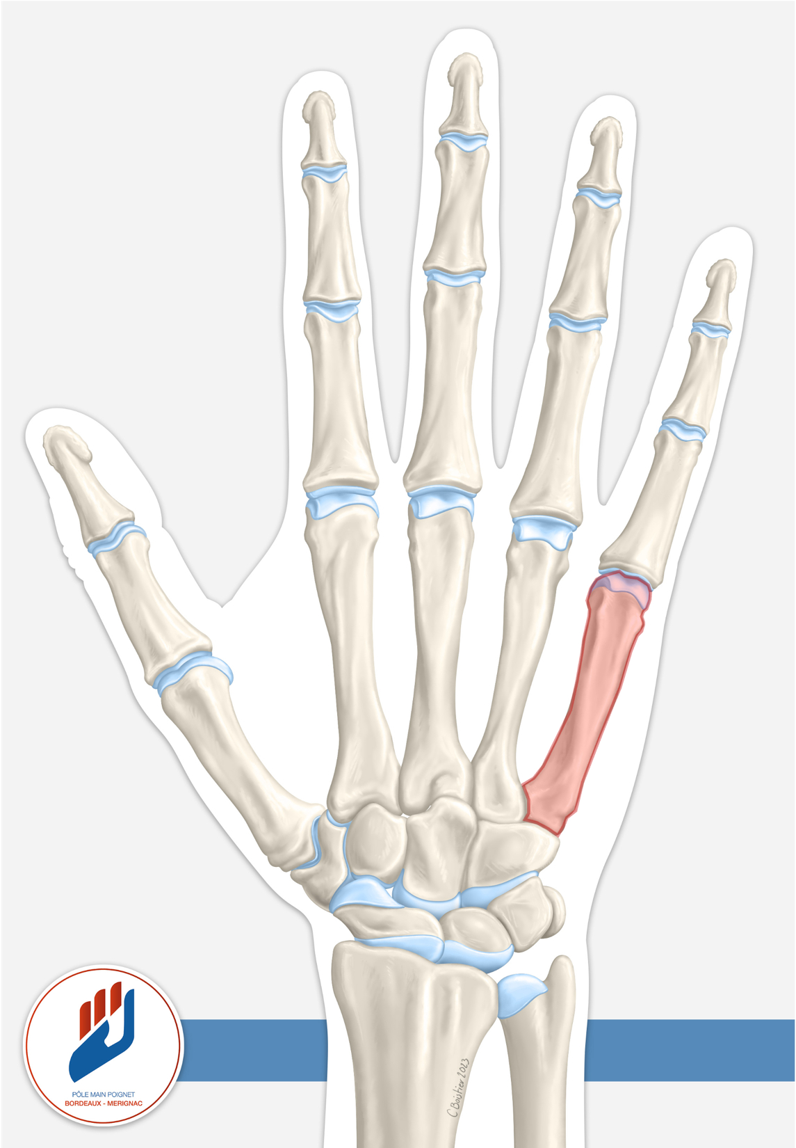 Fracture du 5ème métacarpien à Bordeaux Mérignac