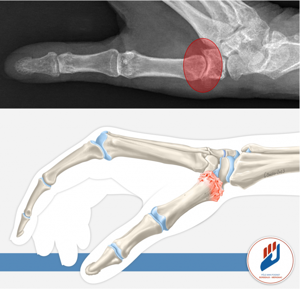 Traitement de la rhizarthrose par implant Pyrocardan® à Bordeaux