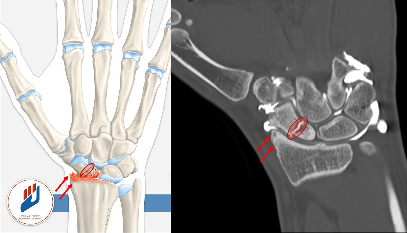 Traitement des pseudarthroses du scaphoïde à Bordeaux