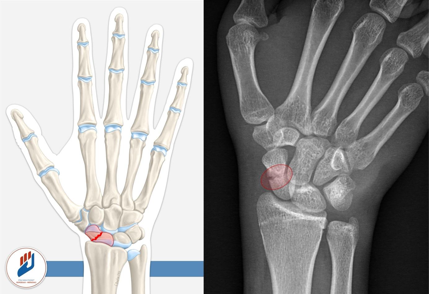 Fracture du scaphoïde à Bordeaux | Clinique du Sport