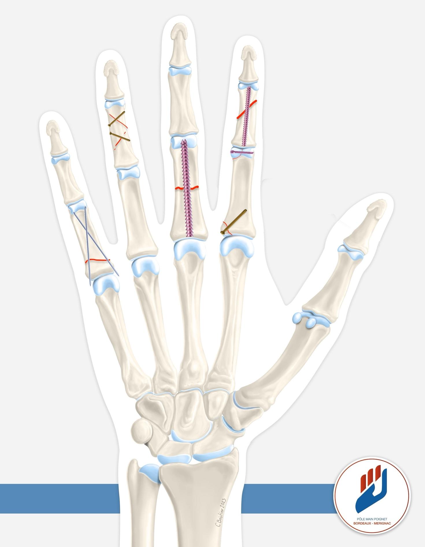 Fractures des phalanges de la main à Bordeaux | Clinique du Sport