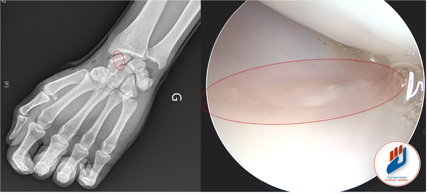 Fracture du scaphoïde à Bordeaux | Clinique du Sport