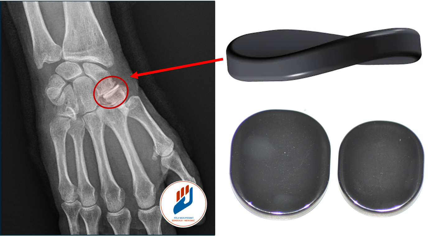 Traitements de l'arthrose STT du poignet à Bordeaux | Clinique du Sport