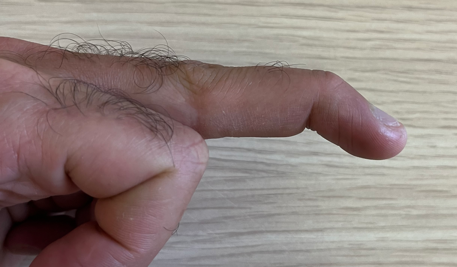 Doigt en maillet (Mallet Finger) : comprendre la lésion et son traitement