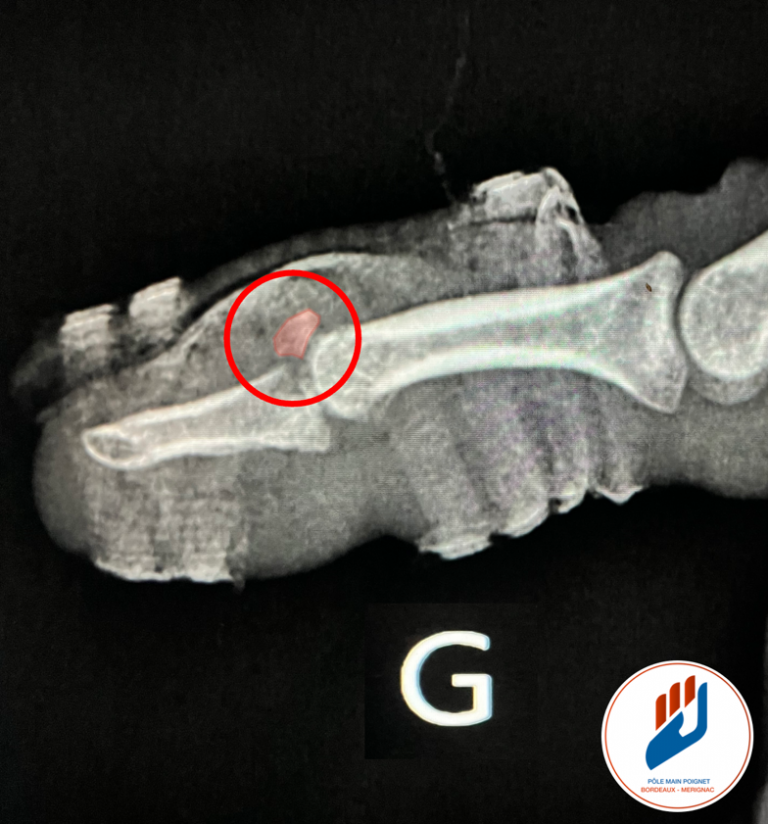 Doigt en maillet (Mallet Finger) : comprendre la lésion et son traitement